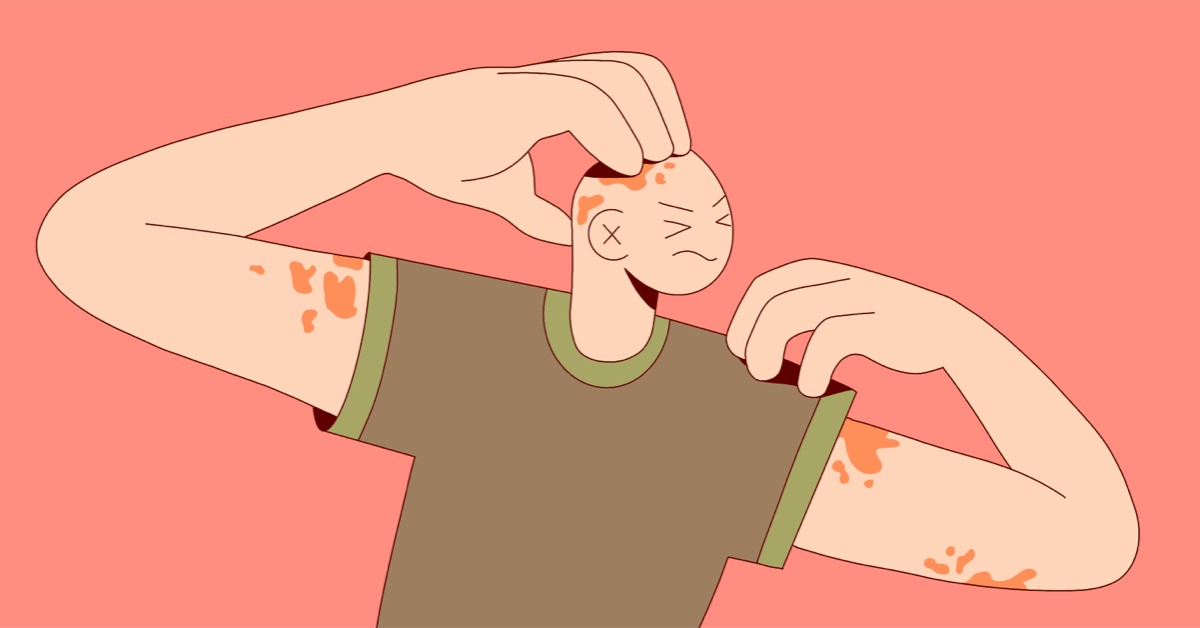 Now I Have Erythema Multiforme | AtopicDermatitis.net